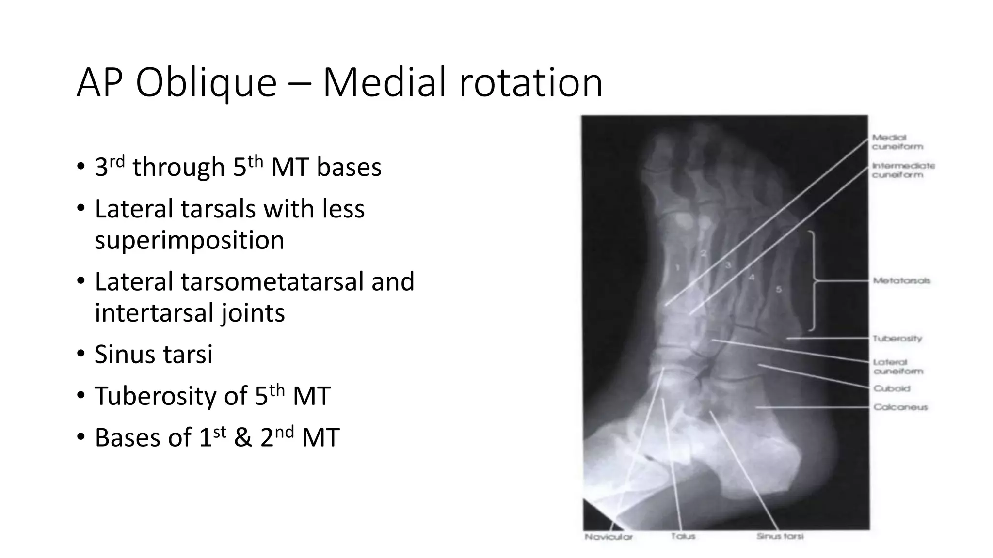 Ankle & Foot Xray & Surgical Approaches | PPTX