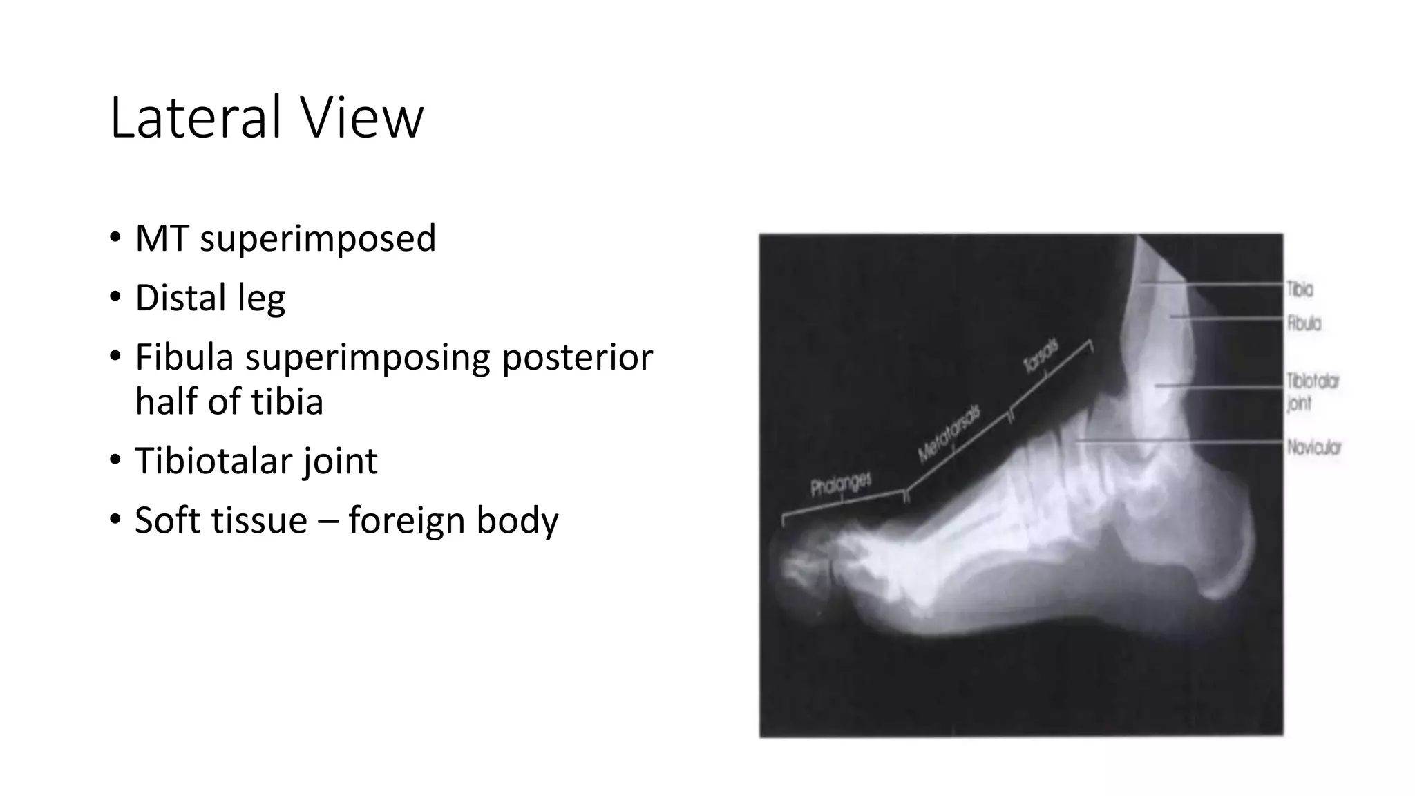 Ankle & Foot Xray & Surgical Approaches | PPTX