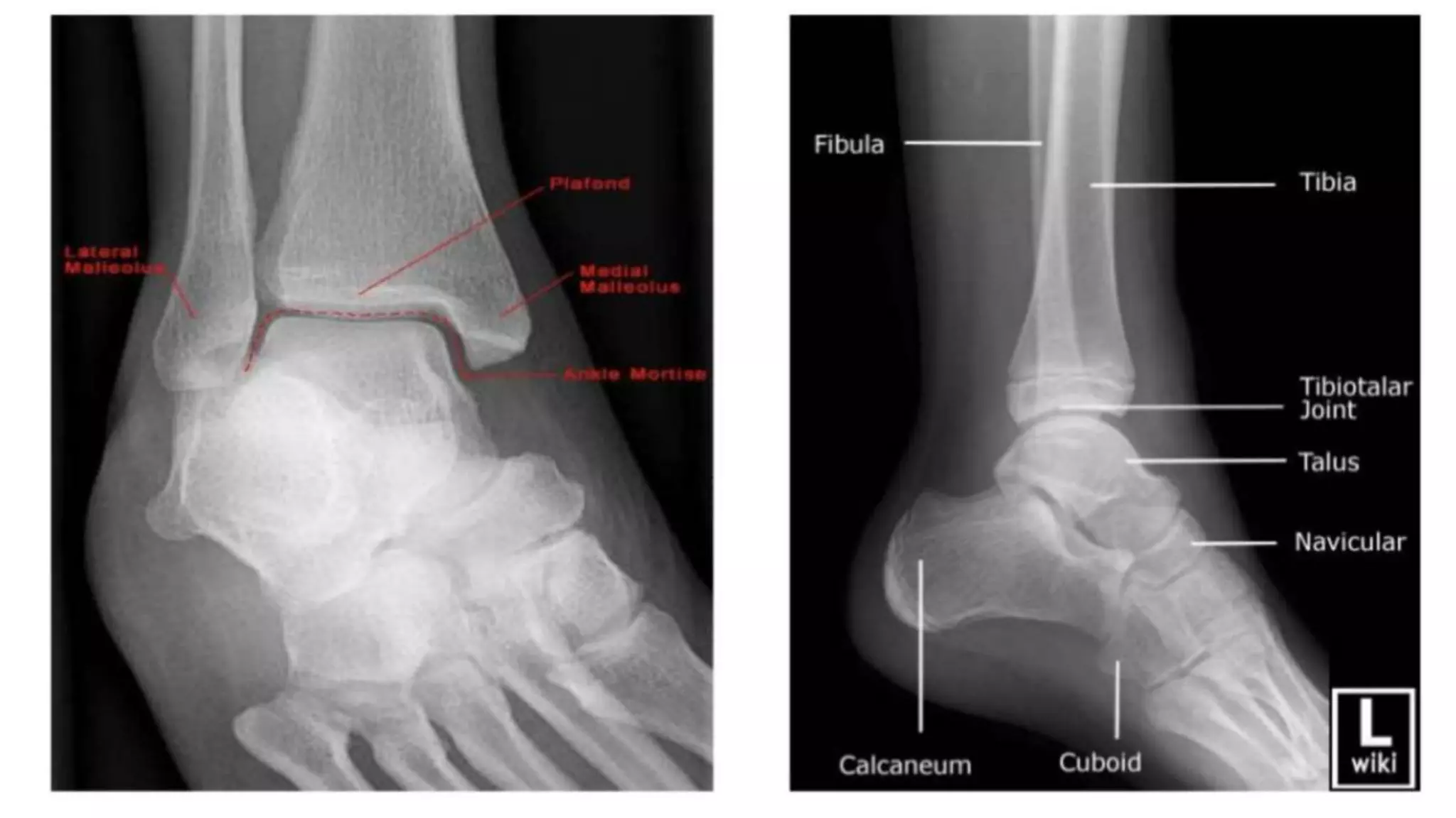 Ankle & Foot Xray & Surgical Approaches | PPTX
