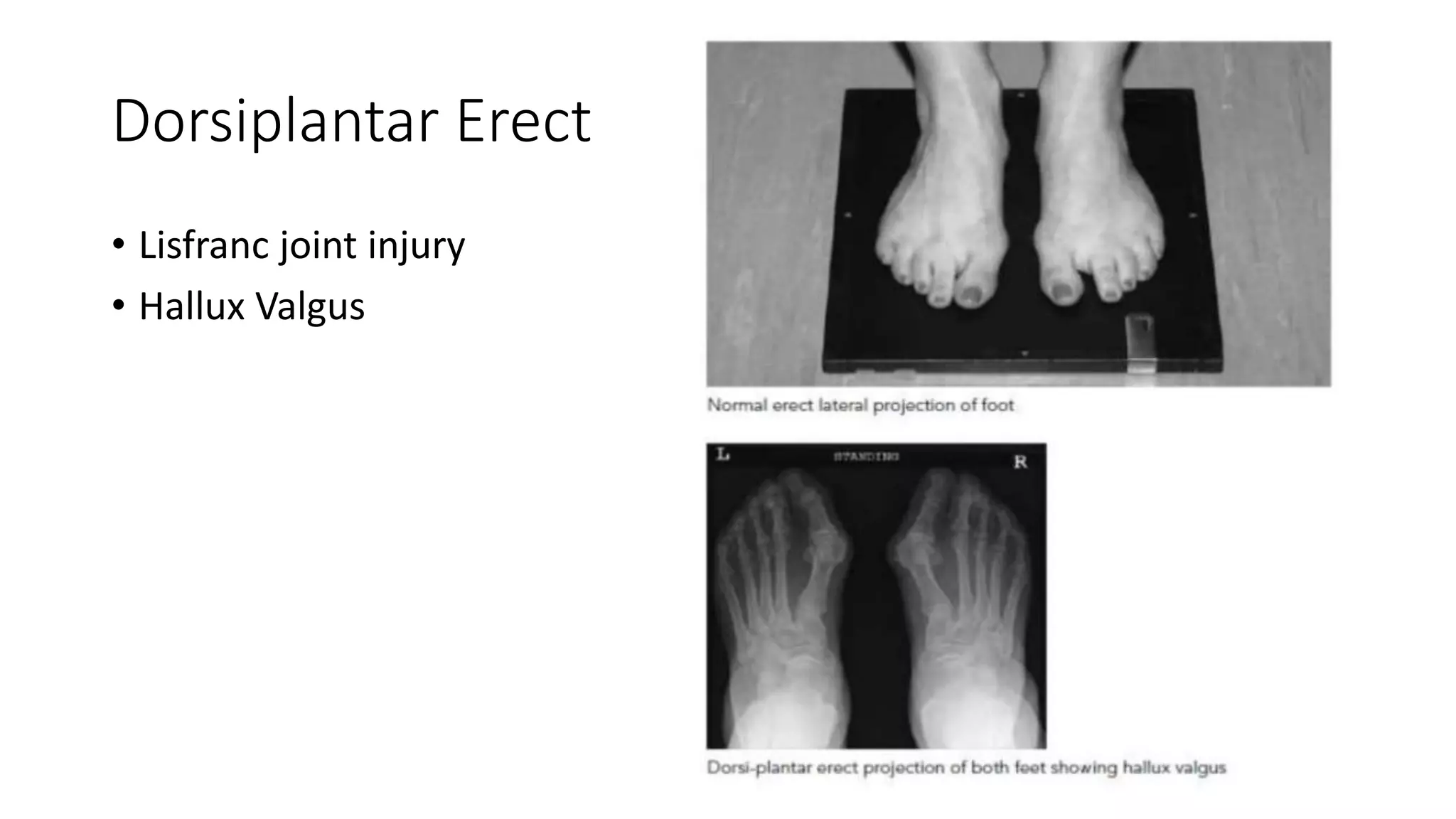 Ankle & Foot Xray & Surgical Approaches | PPTX