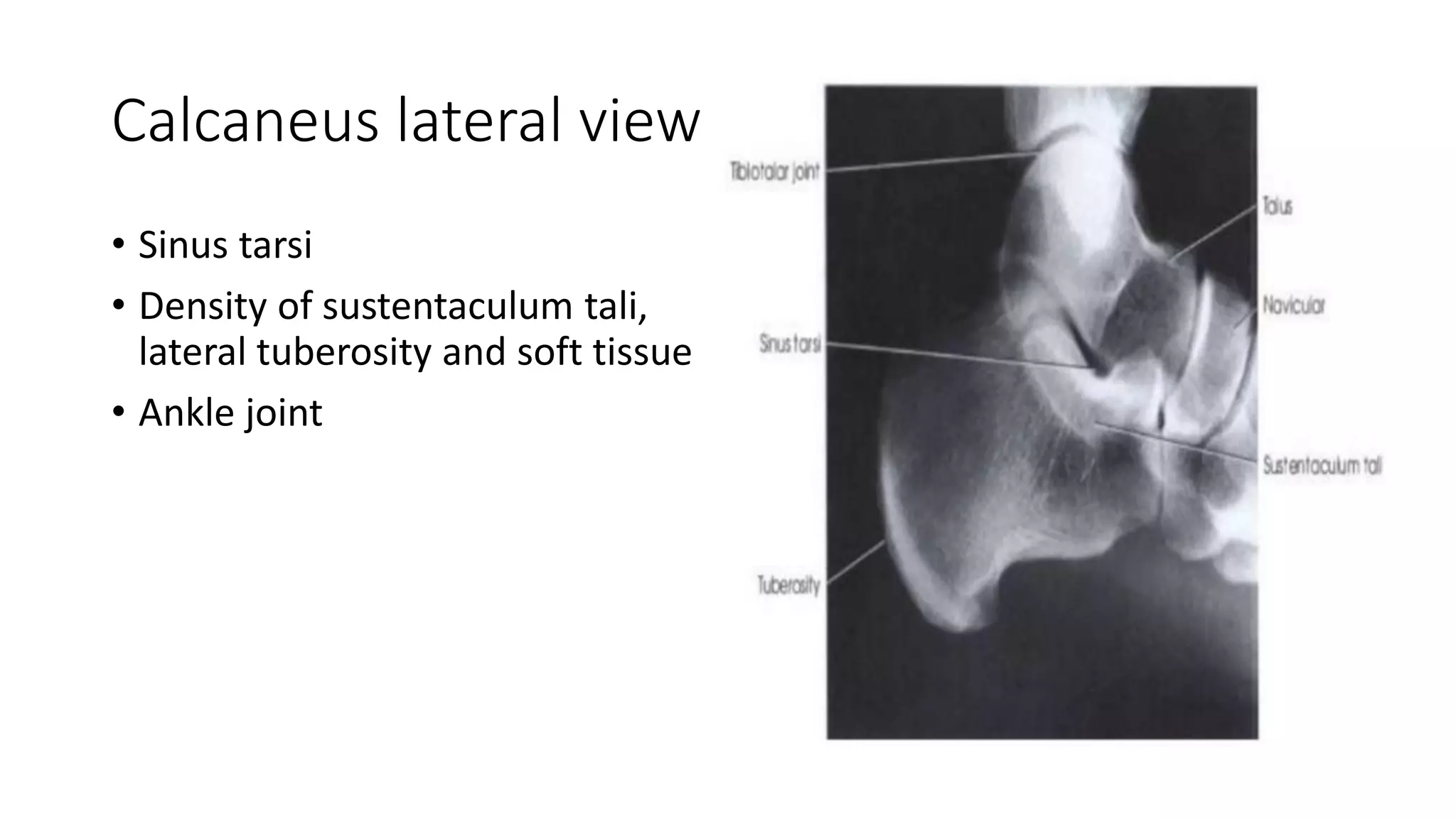 Ankle & Foot Xray & Surgical Approaches | PPTX