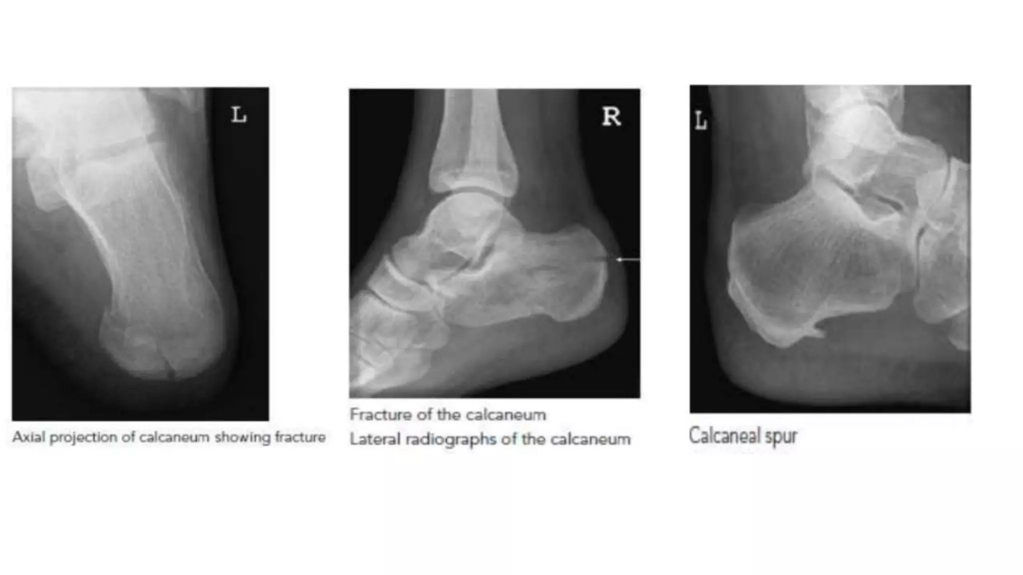 Ankle & Foot Xray & Surgical Approaches | PPTX