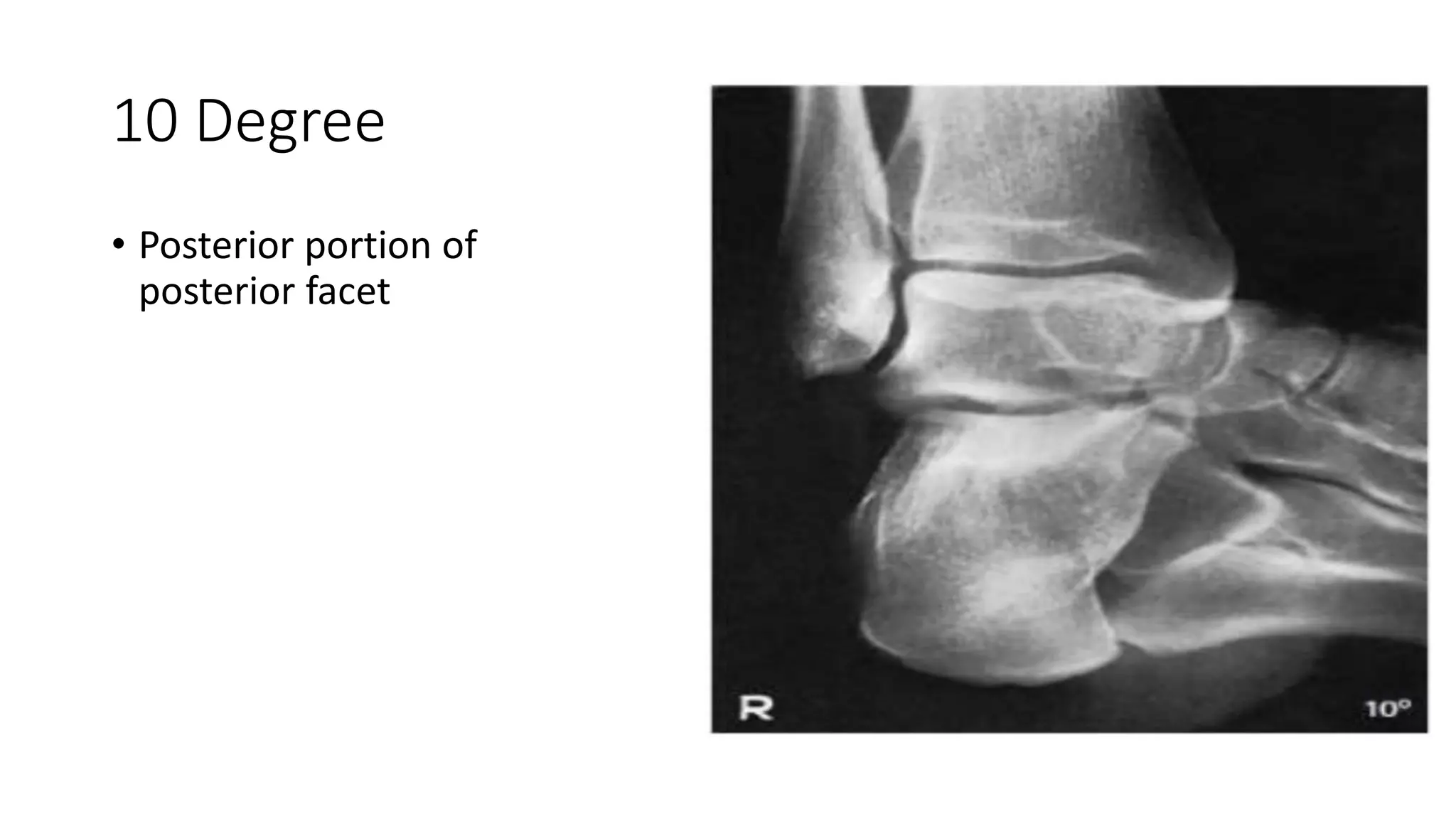 Ankle & Foot Xray & Surgical Approaches | PPTX