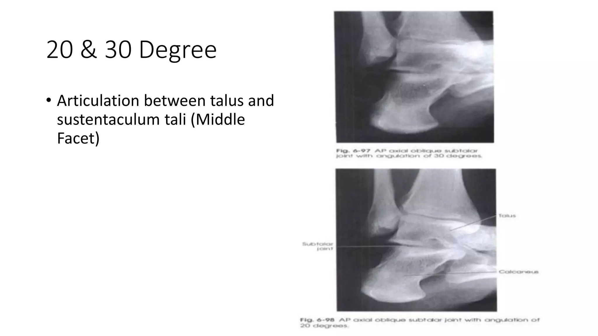 Ankle & Foot Xray & Surgical Approaches | PPTX