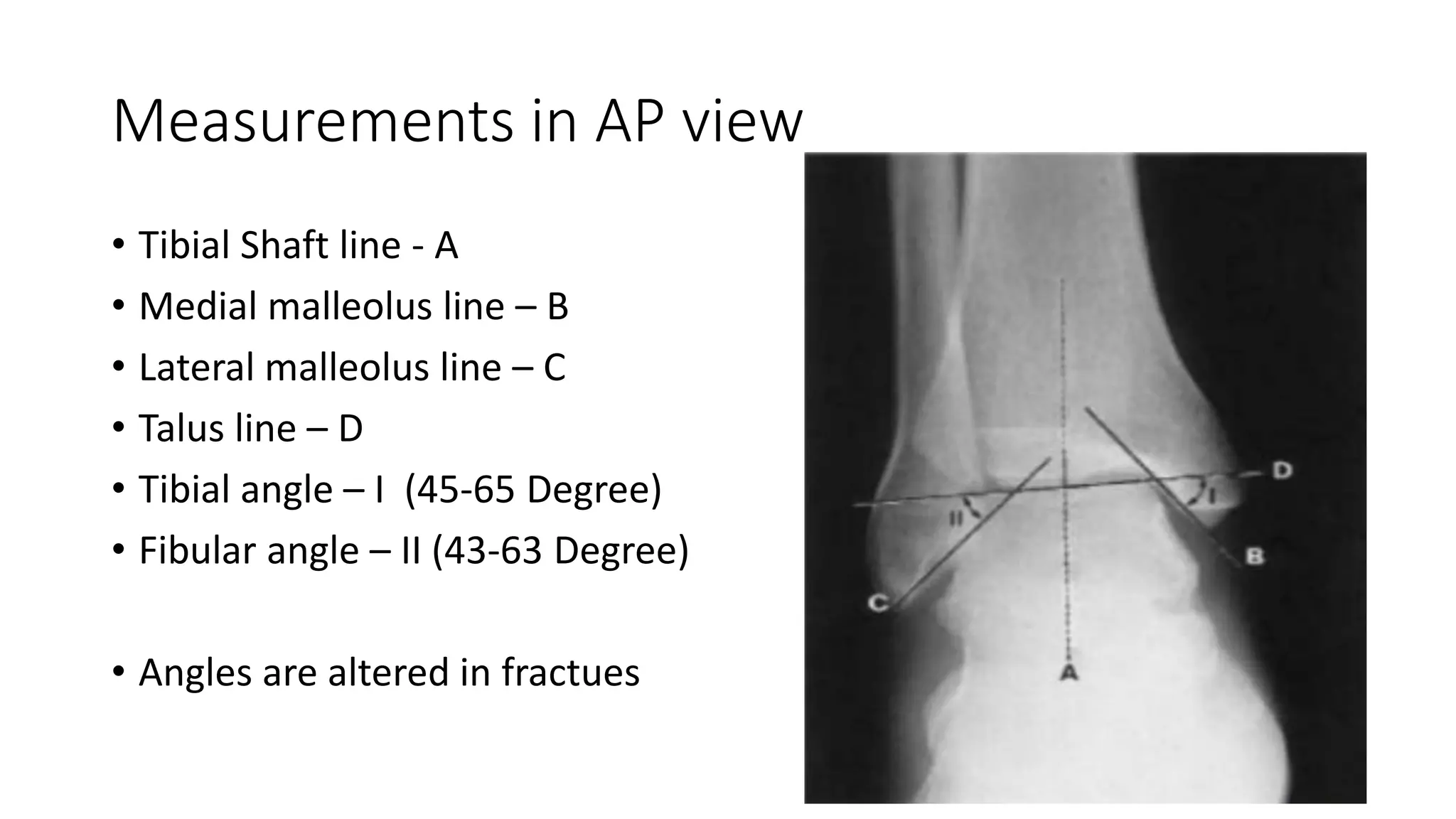 Ankle & Foot Xray & Surgical Approaches | PPTX