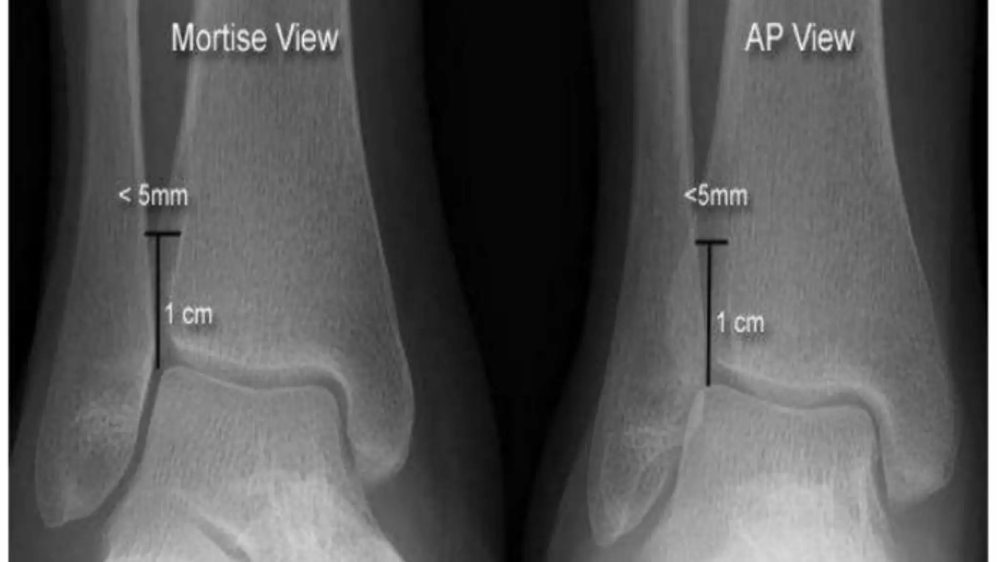 Ankle & Foot Xray & Surgical Approaches | PPTX