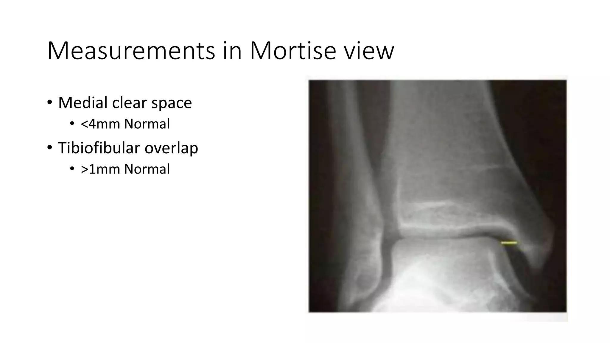 Ankle & Foot Xray & Surgical Approaches | PPTX