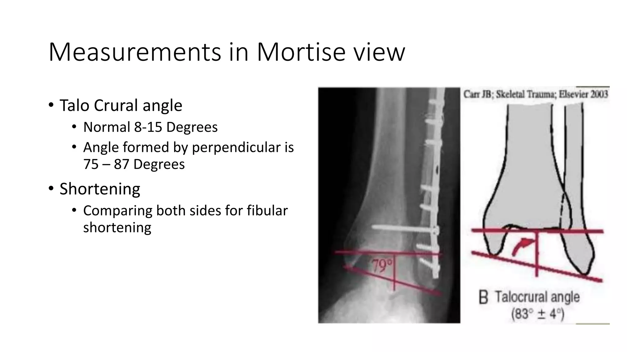 Ankle & Foot Xray & Surgical Approaches | PPTX