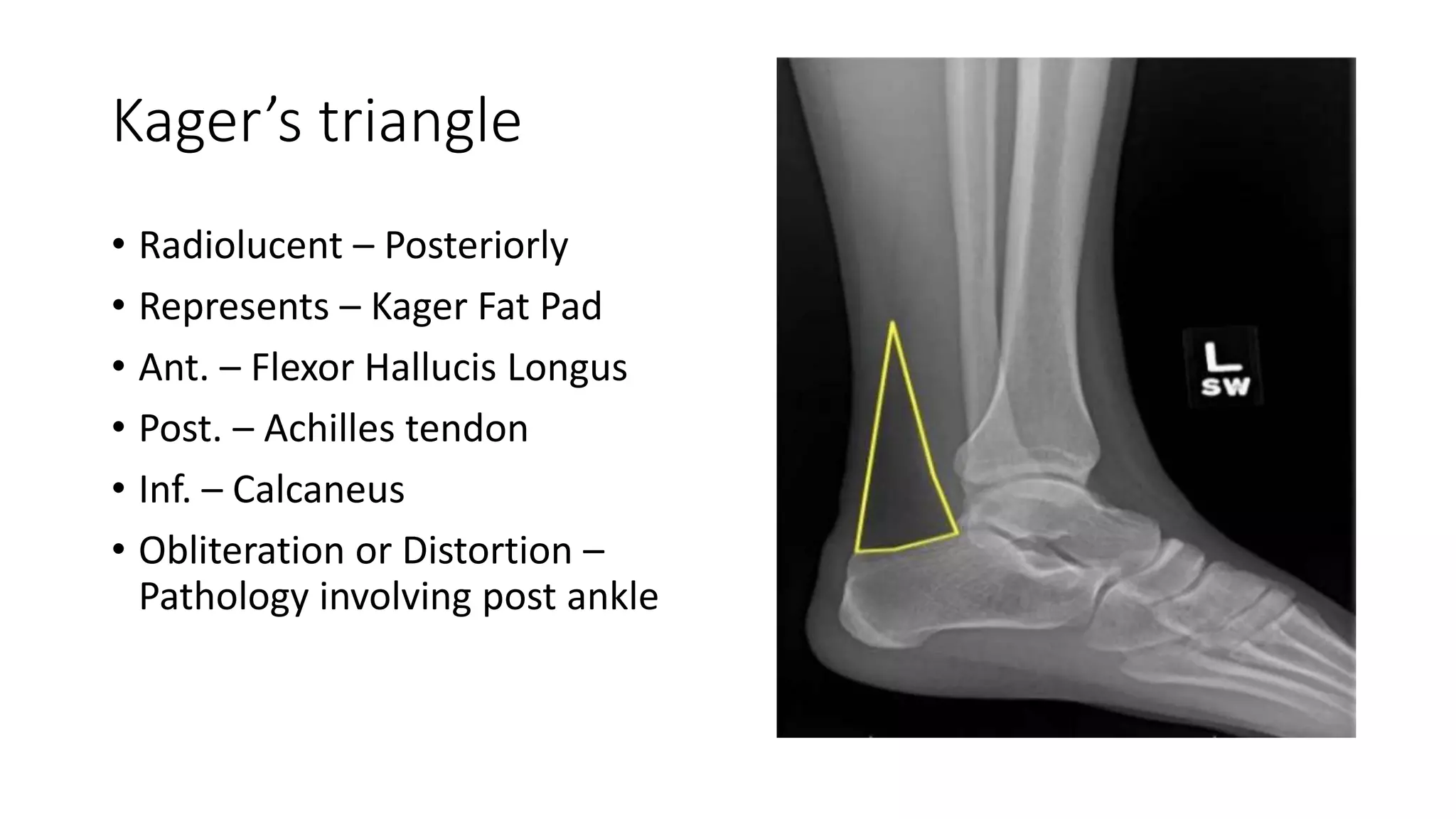 Ankle & Foot Xray & Surgical Approaches | PPTX