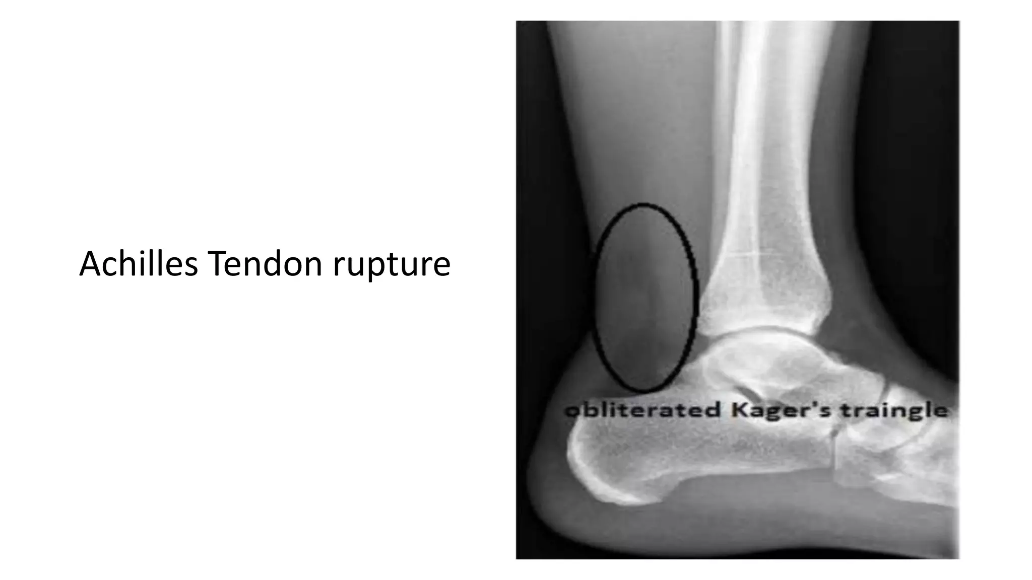 Ankle & Foot Xray & Surgical Approaches | PPTX