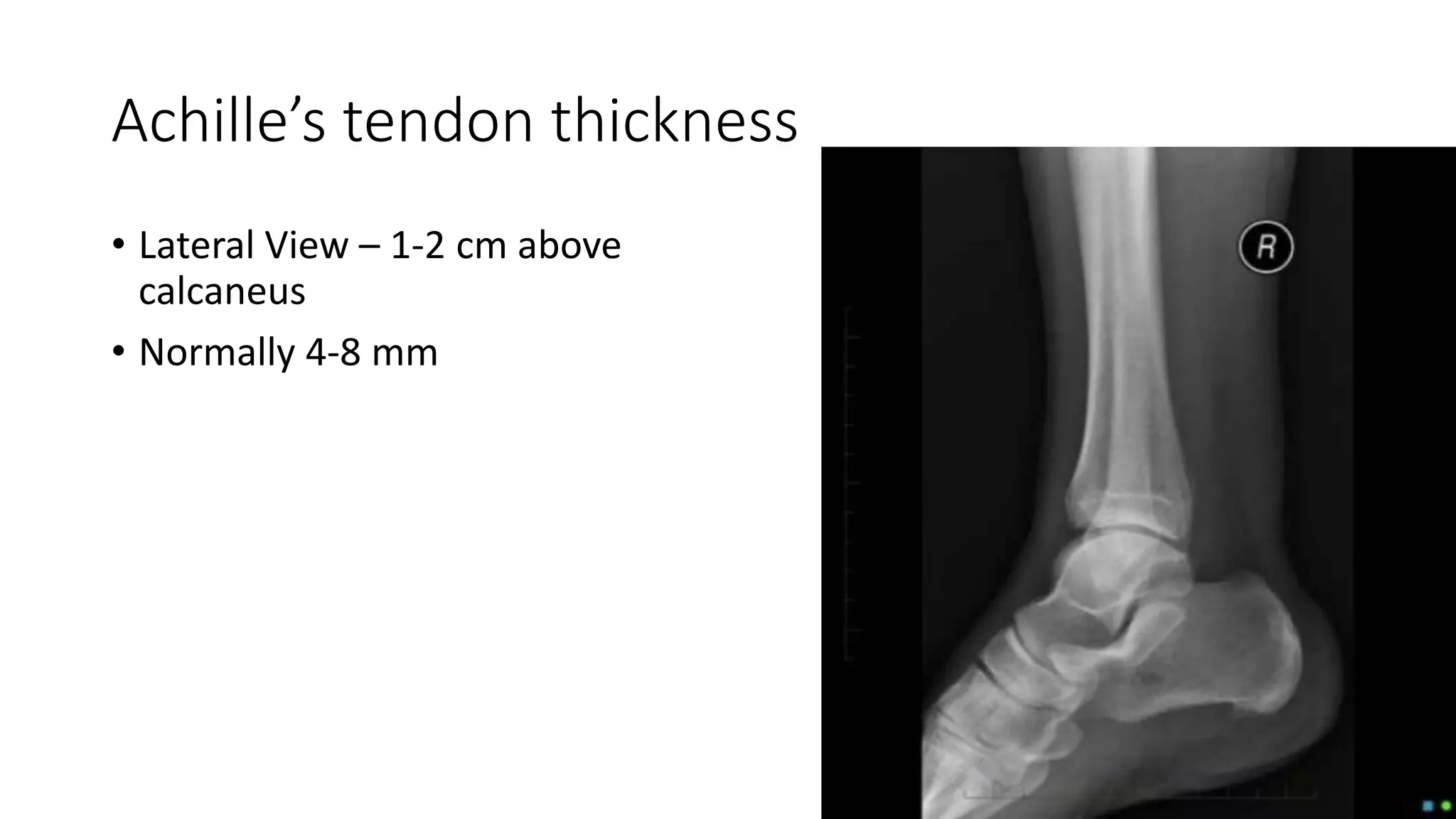 Ankle & Foot Xray & Surgical Approaches | PPTX
