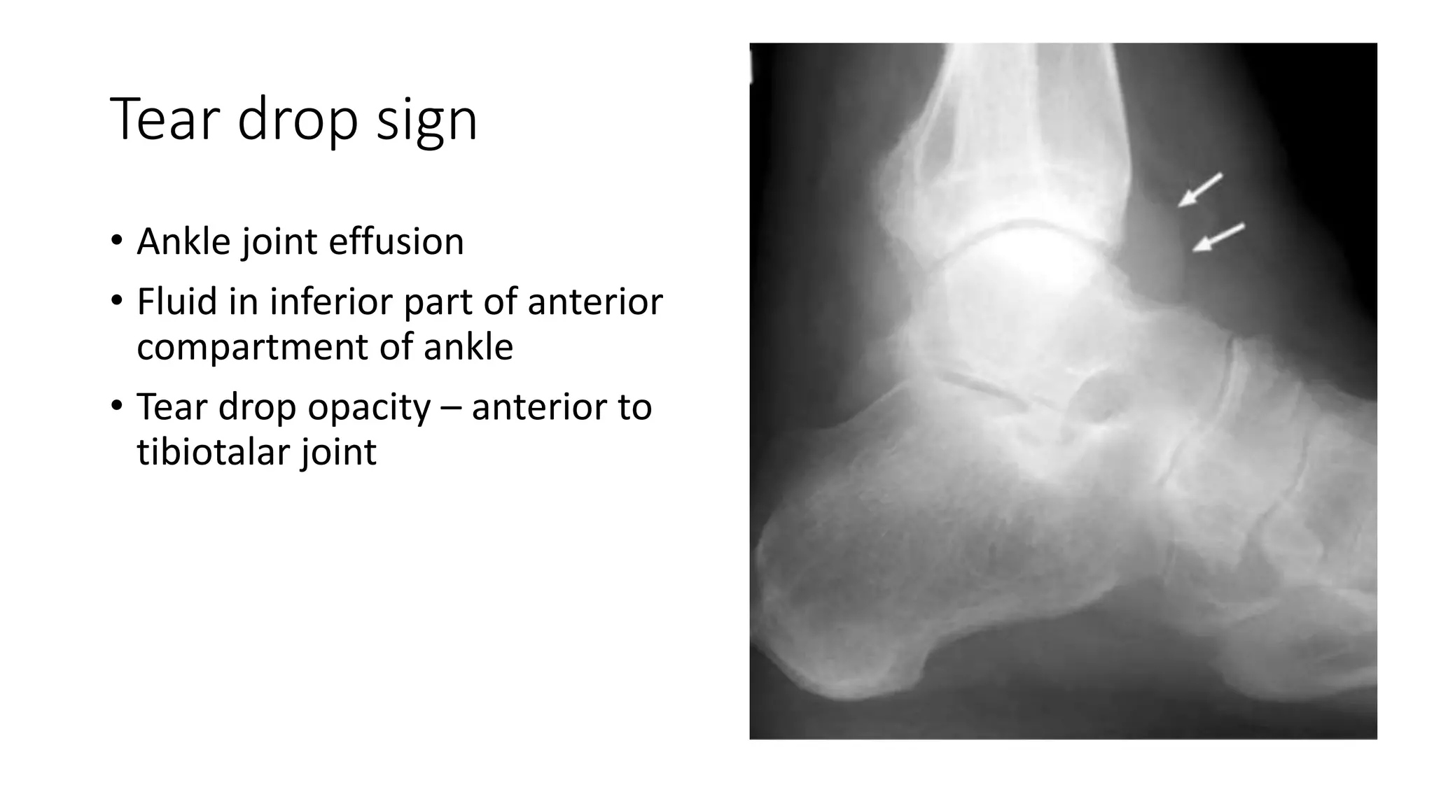Ankle & Foot Xray & Surgical Approaches | PPTX