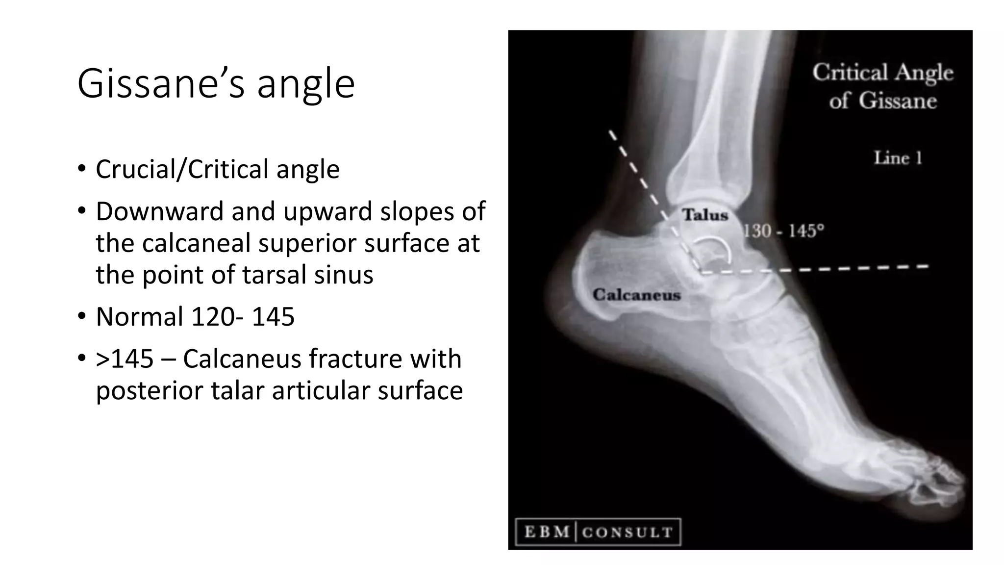 Ankle & Foot Xray & Surgical Approaches | PPTX