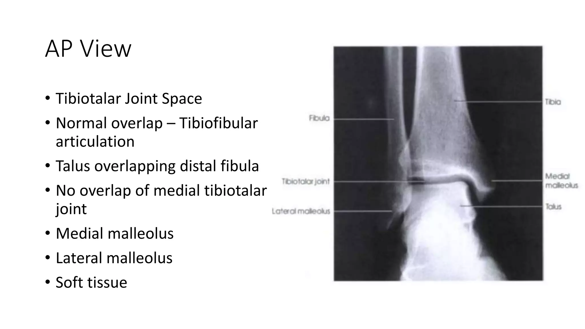 Ankle & Foot Xray & Surgical Approaches | PPTX