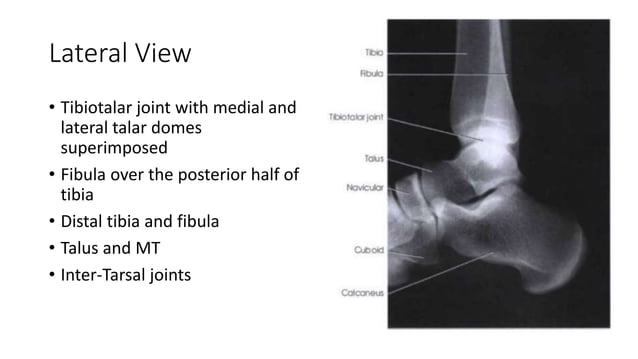 Ankle & Foot Xray & Surgical Approaches | PPTX