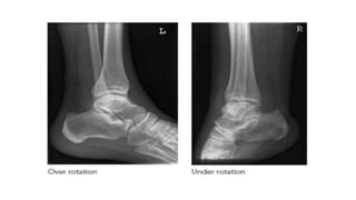 Ankle & Foot Xray & Surgical Approaches | PPTX