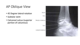 Ankle & Foot Xray & Surgical Approaches | PPTX