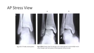 Ankle & Foot Xray & Surgical Approaches | PPTX
