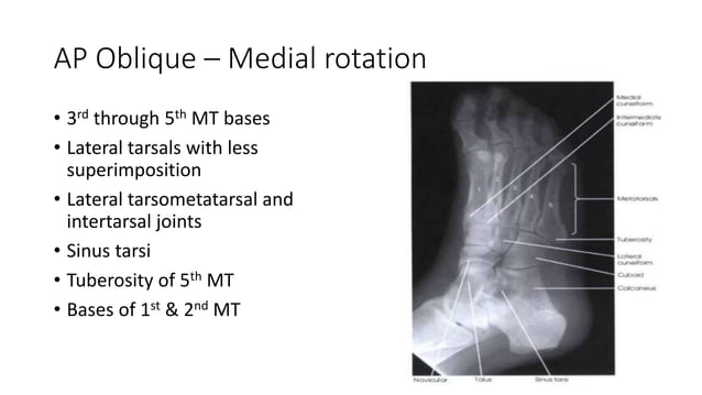 Ankle & Foot Xray & Surgical Approaches | PPTX