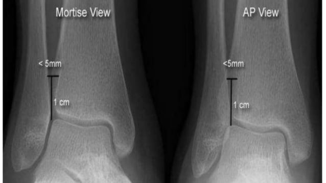 Ankle & Foot Xray & Surgical Approaches | PPTX