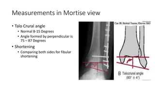 Ankle & Foot Xray & Surgical Approaches | PPTX