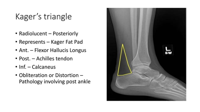Ankle & Foot Xray & Surgical Approaches | PPTX