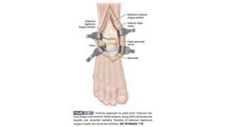 Ankle & Foot Xray & Surgical Approaches | PPTX