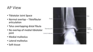 Ankle & Foot Xray & Surgical Approaches | PPTX
