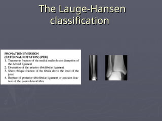 Fracture of the treataNKLE FRACTURE-1.ppt