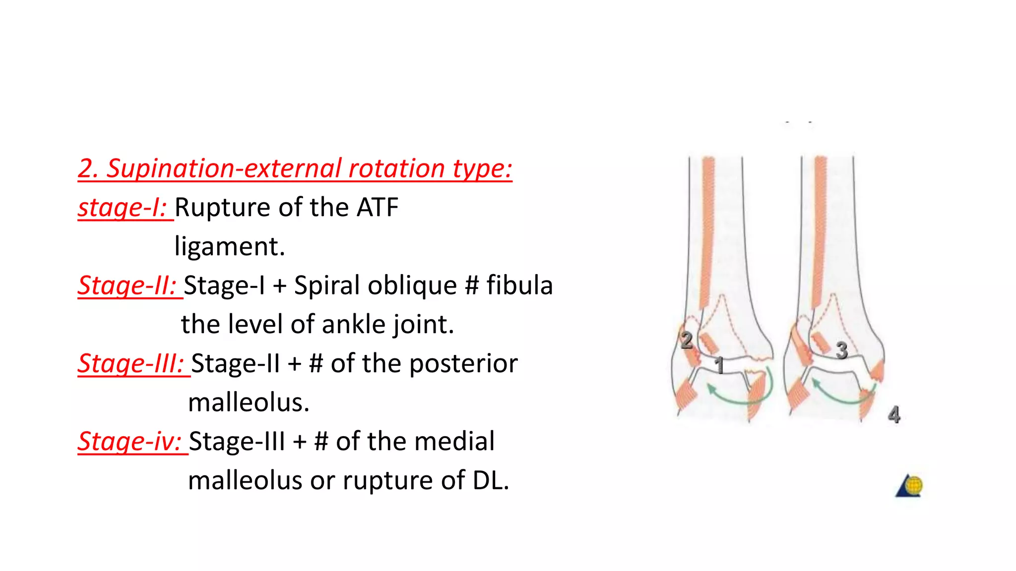 Ankle fracture | PPTX