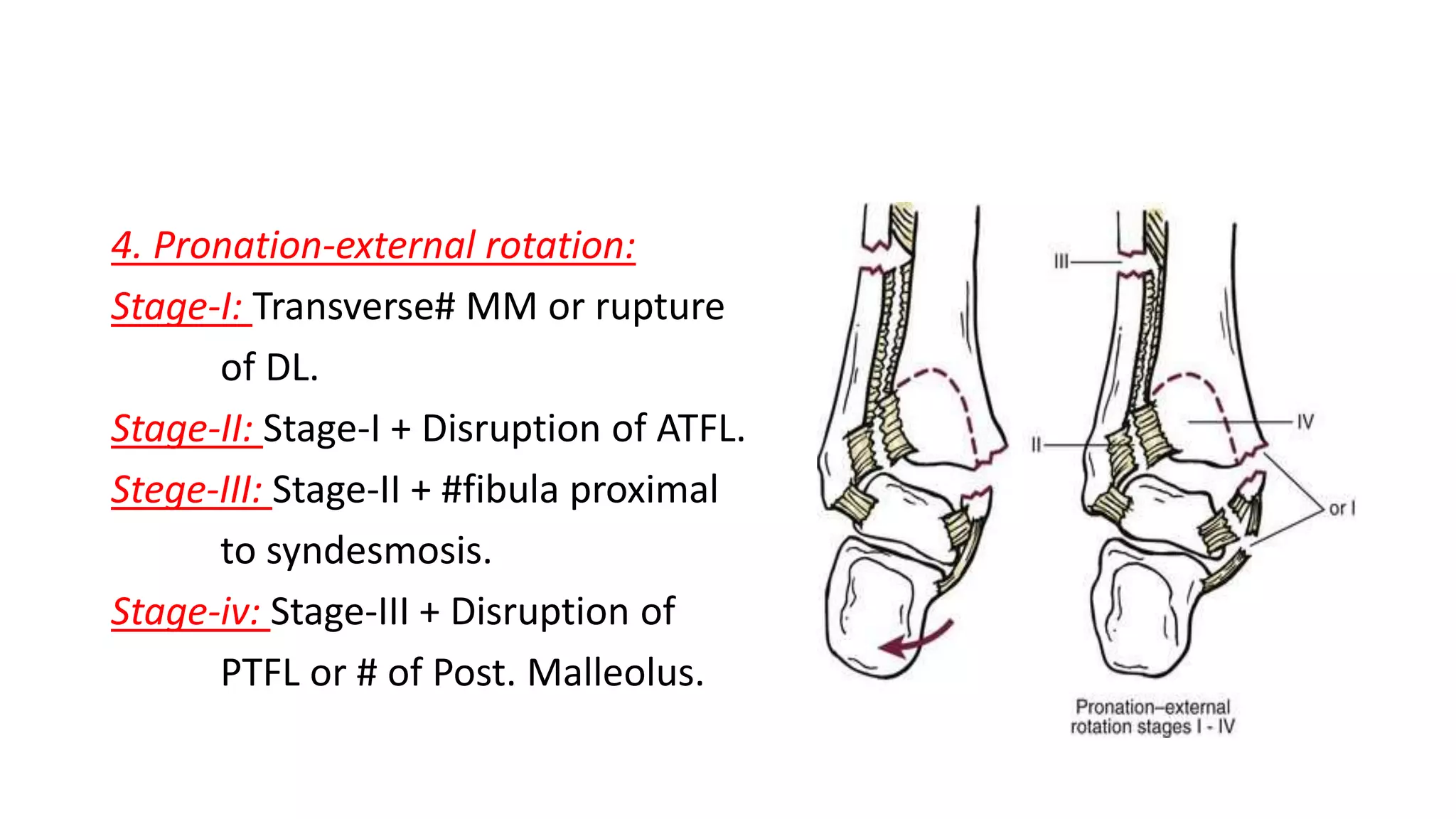 Ankle fracture | PPTX