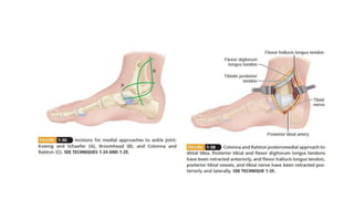 Ankle fracture | PPTX