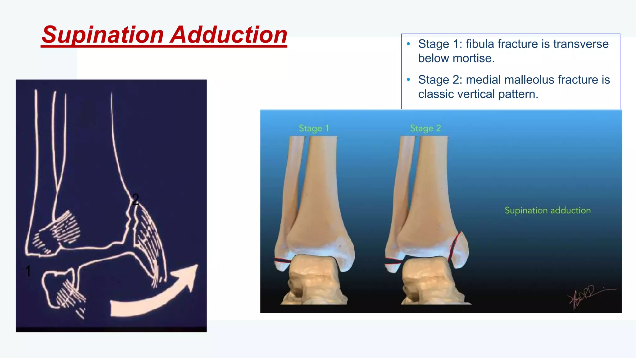 Ankle fracture | PPTX