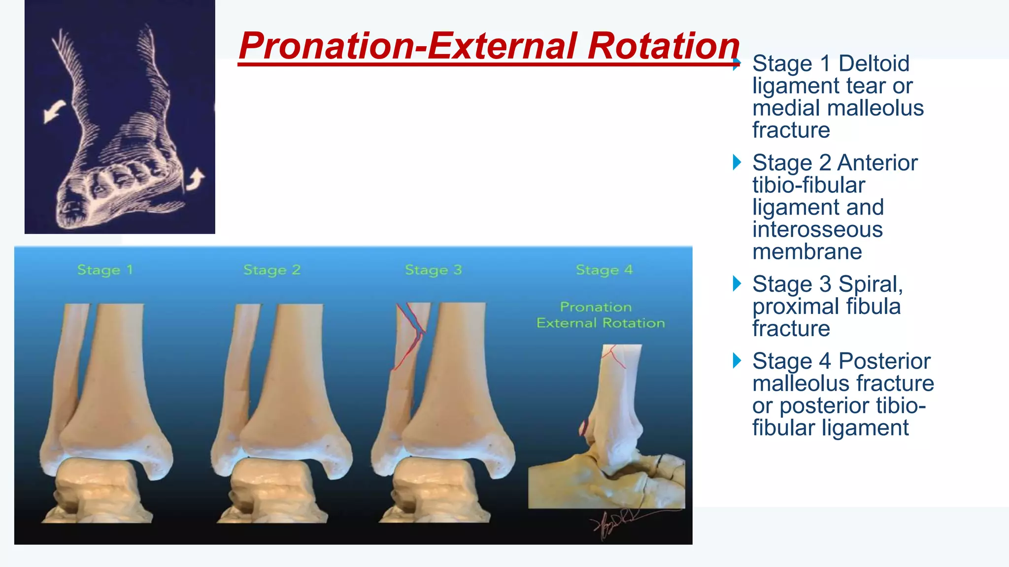 Ankle fracture | PPTX
