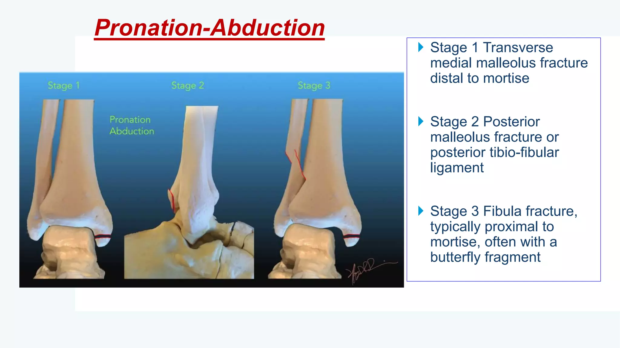 Ankle fracture | PPTX
