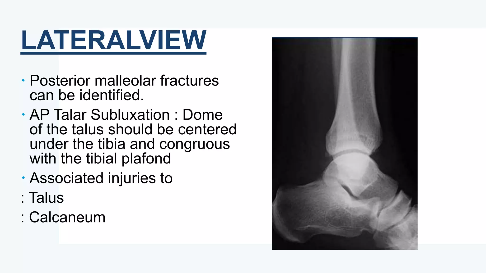 Ankle fracture | PPTX