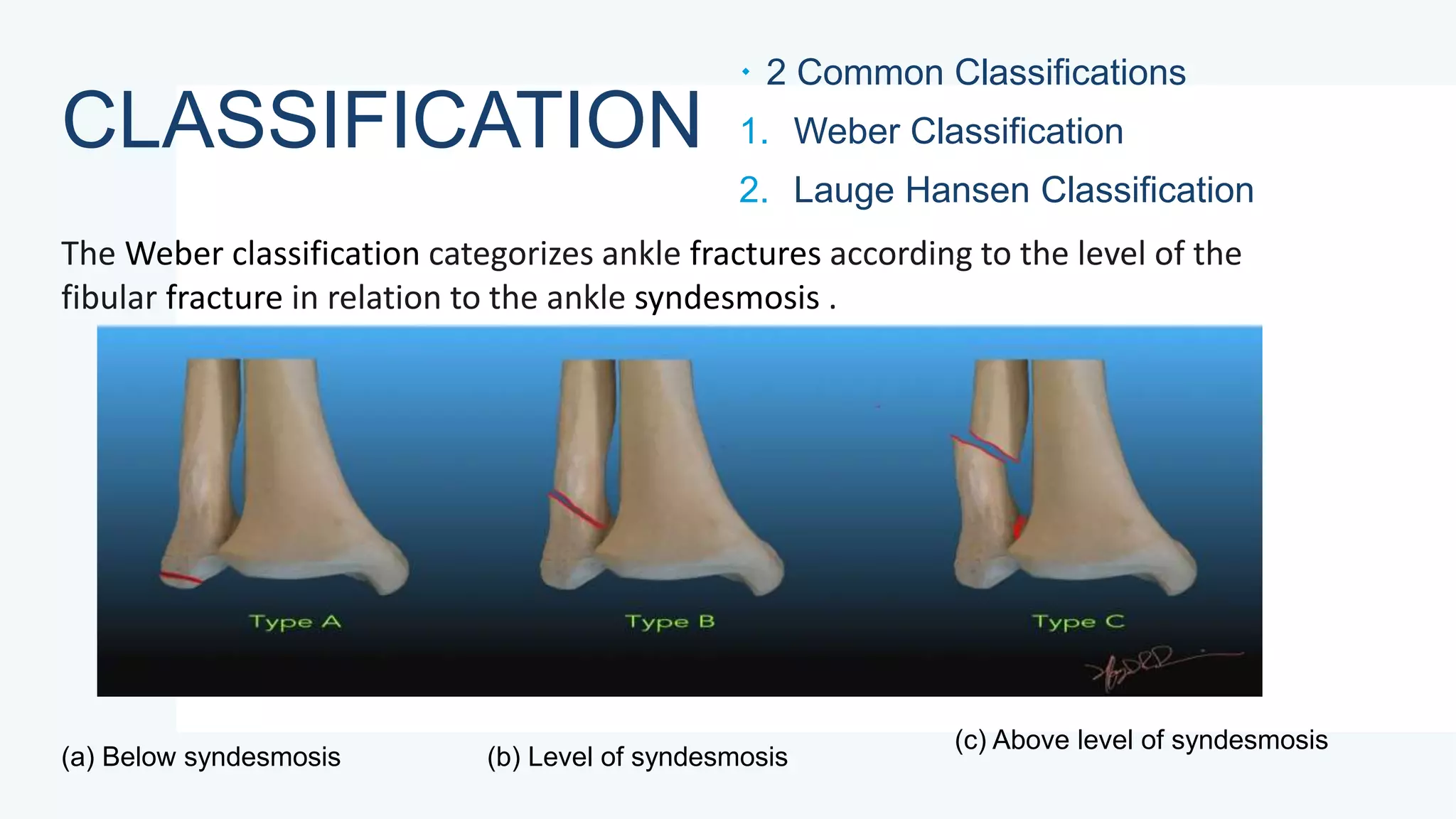 Ankle fracture | PPTX