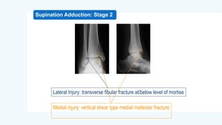Ankle fracture | PPTX