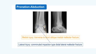Ankle fracture | PPTX