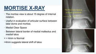 Ankle fracture | PPTX