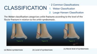 Ankle fracture | PPTX