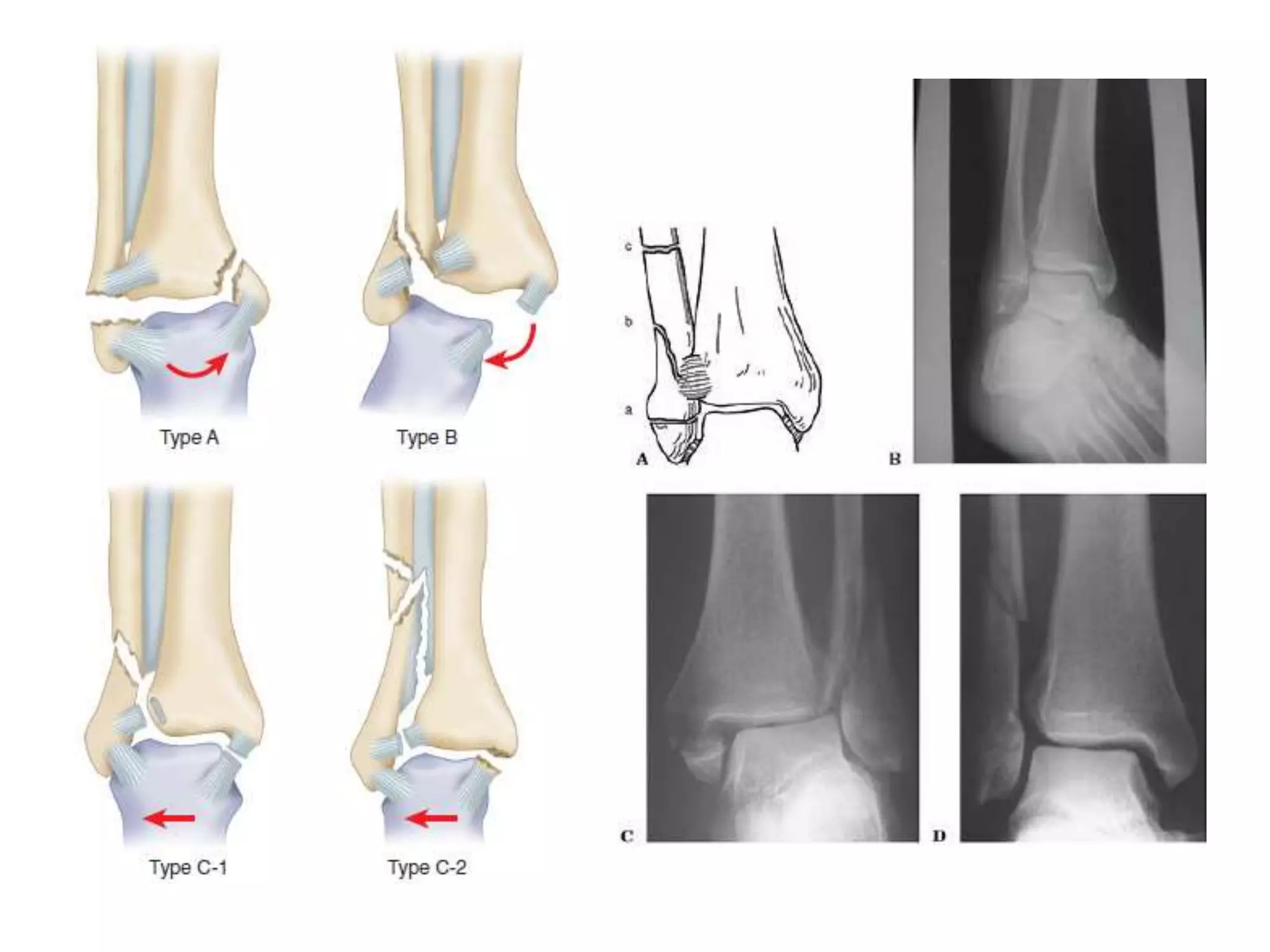 Ankle Fracture | PPTX
