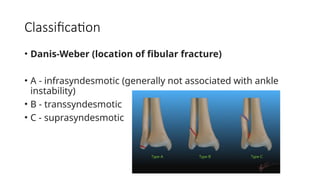 Ankle Fracture all in all with short and sweet | PPT