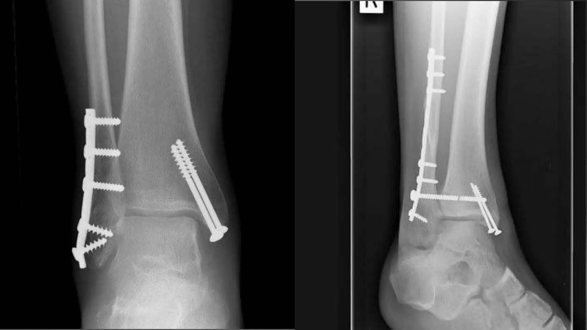 ankle fracture F2.pptx