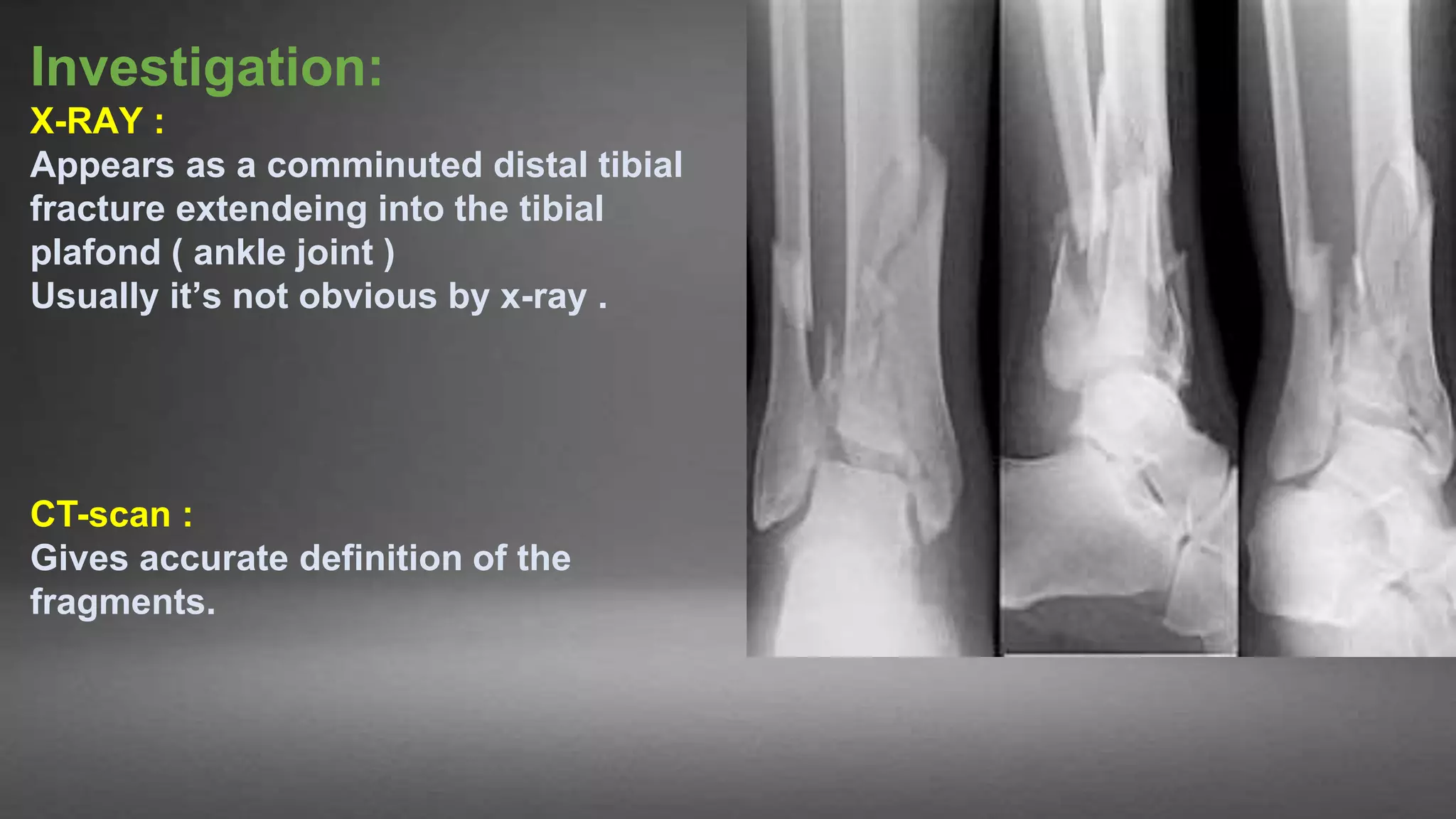 ankle fracture F2.pptx