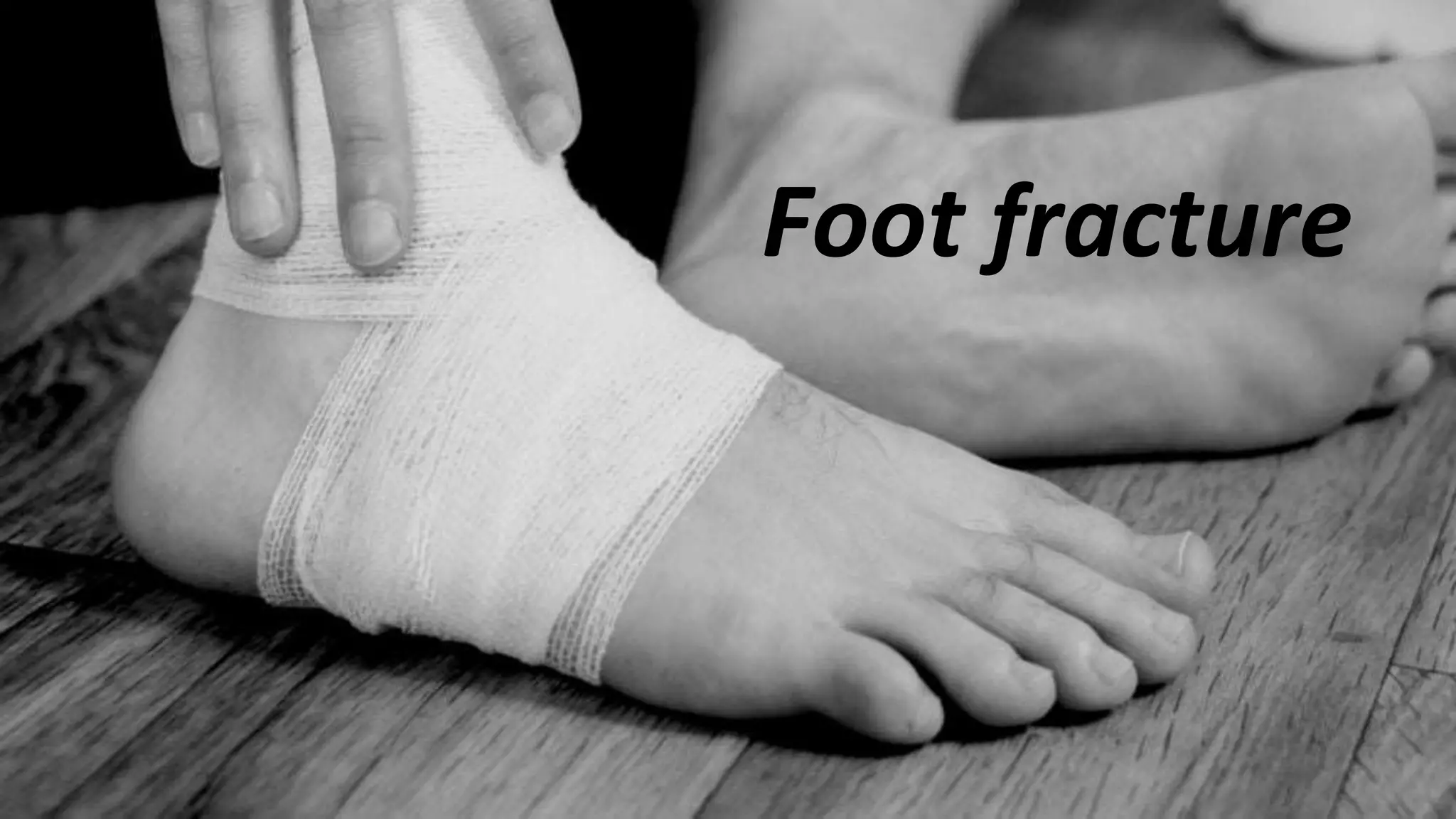 ankle fracture F2.pptx