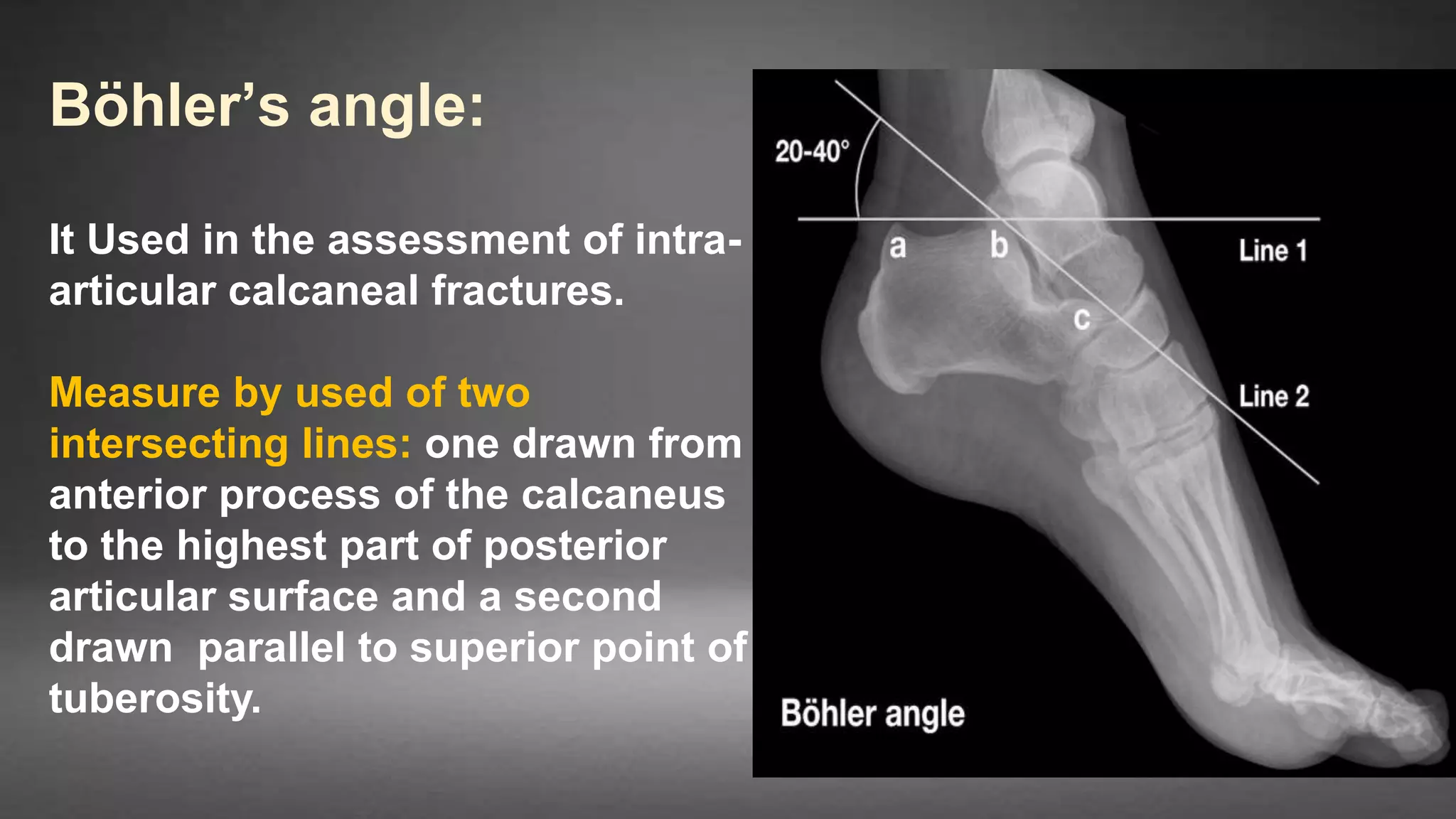 ankle fracture F2.pptx