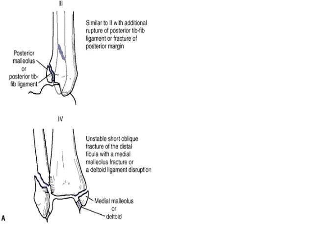 Ankle fractures