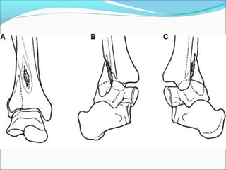Ankle fractures | PPT