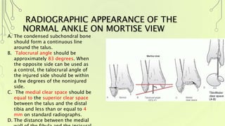 Ankle fractures | PPTX